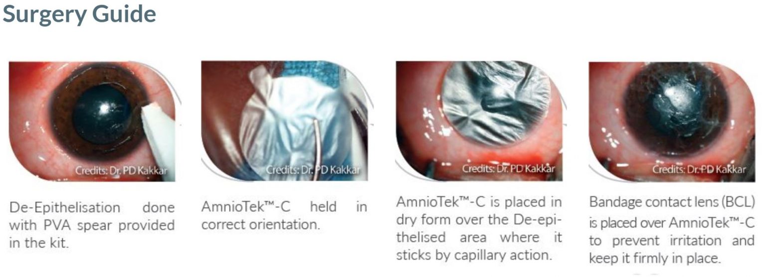 AmnioTek Vision kit Medix 21 Surgical | Looking to the future